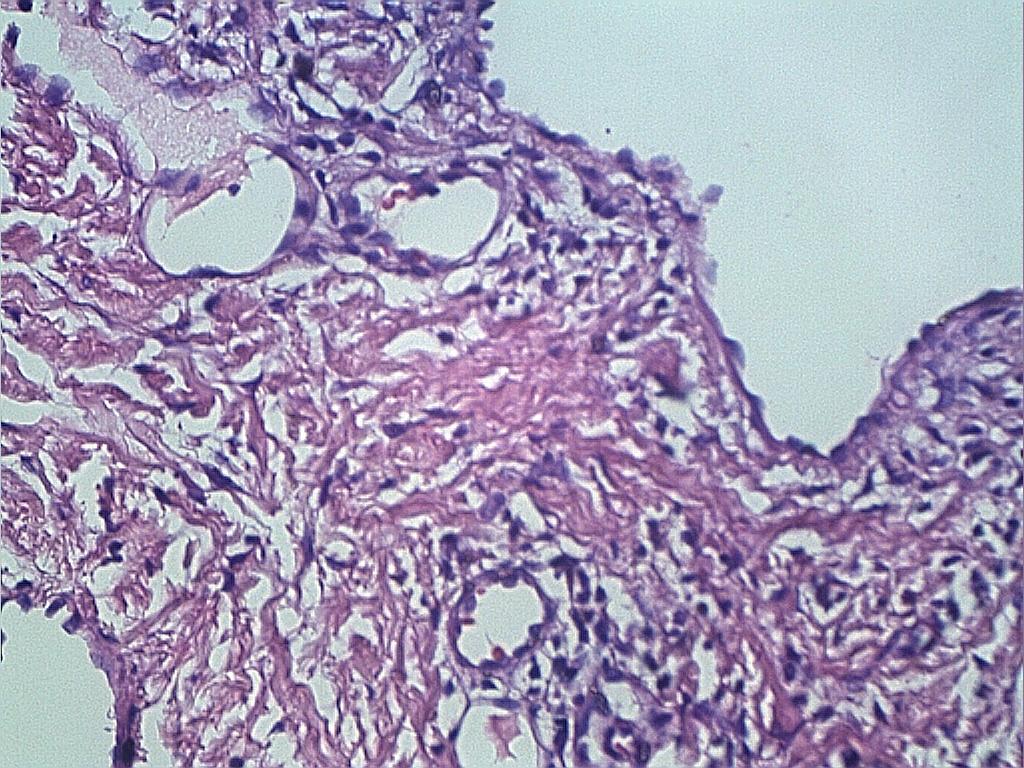 Consulta a un Colega N°4: Placa pápulo-vesiculosa de aspecto vascular ...