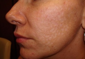 Consulte a un Colega N°3: Hipomelanosis en confetti – PIEL-L ...