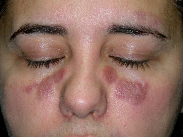 219 Consulta a un Colega No. 6 – PIEL-L Latinoamericana