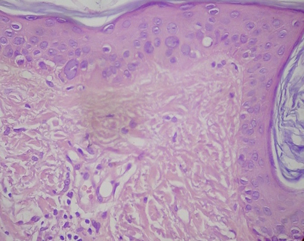 Consulte a un Colega Nº5: Lupus Eritematoso cutáneo remedando ...