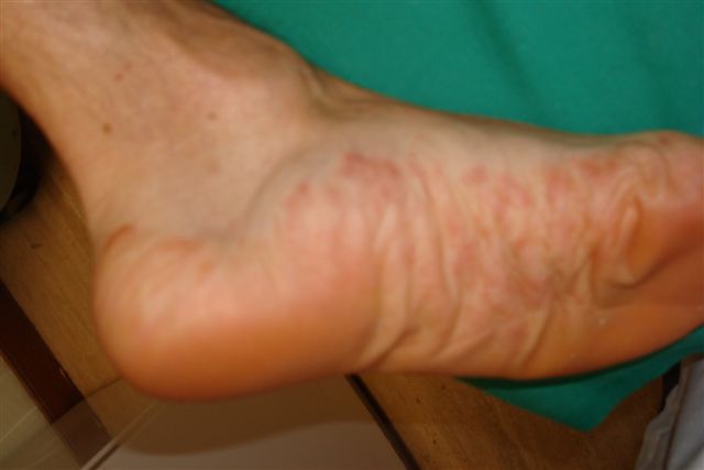 Consulta a un Colega Nº4: Pitiriasis Rubra Pilar aguda. Como manejarla ...