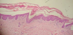 Consulta a un Colega Nº4: Pitiriasis Rubra Pilar aguda. Como manejarla ...