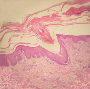 Consulta a un Colega Nº4: Pitiriasis Rubra Pilar aguda. Como manejarla ...
