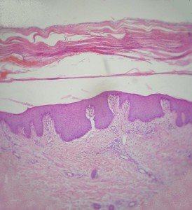 Consulta a un Colega Nº4: Pitiriasis Rubra Pilar aguda. Como manejarla ...
