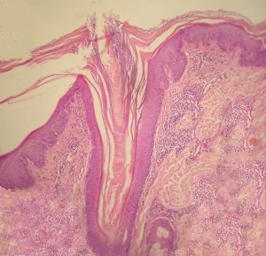 Consulta a un Colega Nº4: Pitiriasis Rubra Pilar aguda. Como manejarla ...