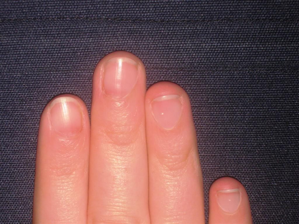 Consulta a un Colega Nº 1: Caso de uñas – PIEL-L Latinoamericana