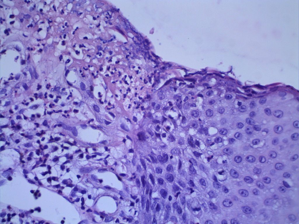 Consulte a un Colega Nº4: Lesión exulcerada/ulcerada, eritematosa ...