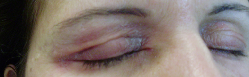 Dermatitis por contacto en parpados: alergia al níquel o a cosméticos ...