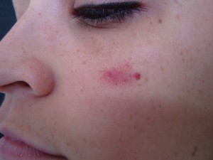 231 – Consulta a un Colega Nº5: Nevo telangiectásico (mancha salmón) VS ...