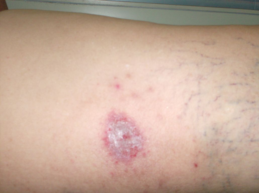 231 – Consulte a un Colega Nº8. Placas alargadas y redondeadas – PIEL-L ...