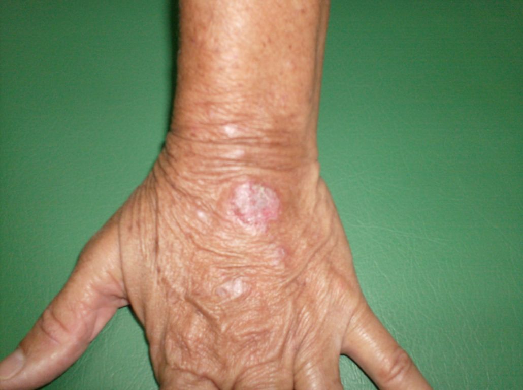 231 – Consulte a un Colega Nº8. Placas alargadas y redondeadas – PIEL-L ...