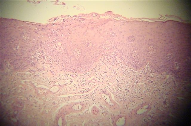 Consulta a un Colega Nº3: Psoriasis en pene? – PIEL-L Latinoamericana