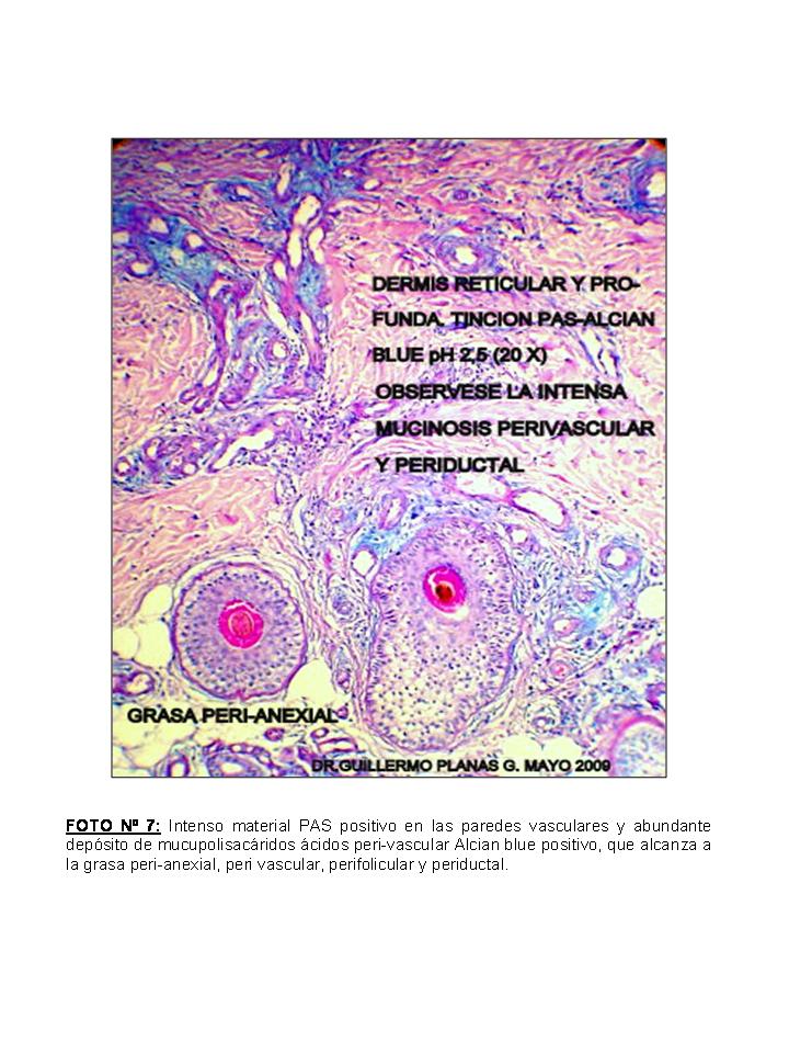Vasculitis livedoide – PIEL-L Latinoamericana