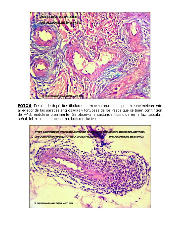 Vasculitis livedoide – PIEL-L Latinoamericana