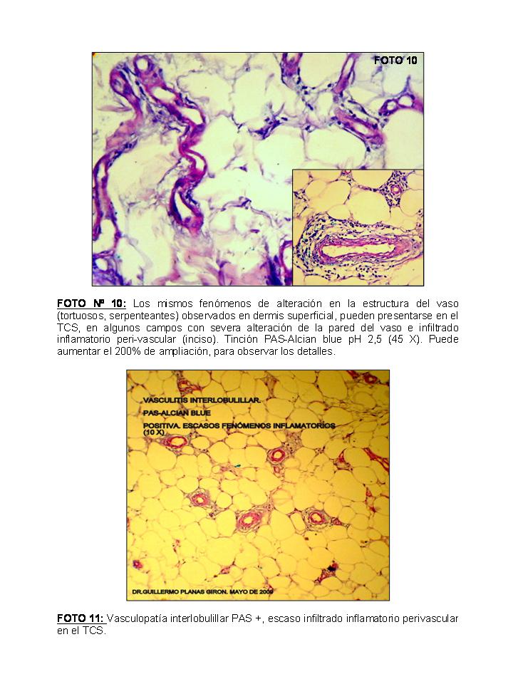 Vasculitis livedoide – PIEL-L Latinoamericana