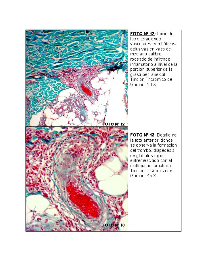 Vasculitis livedoide – PIEL-L Latinoamericana