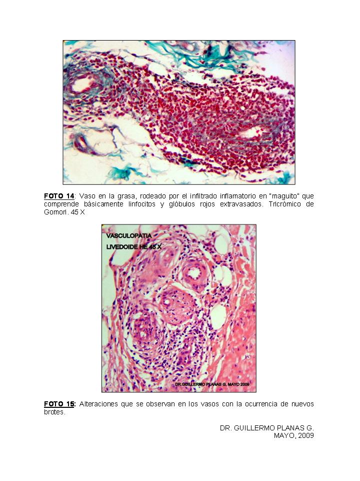 Vasculitis livedoide – PIEL-L Latinoamericana