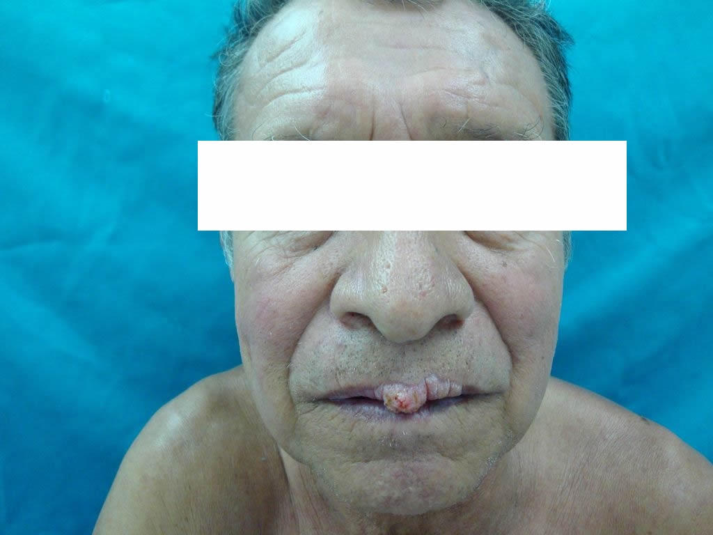 233 – Consulta a un Colega Nº1: Condiloma Acuminado. VPH? – PIEL-L ...