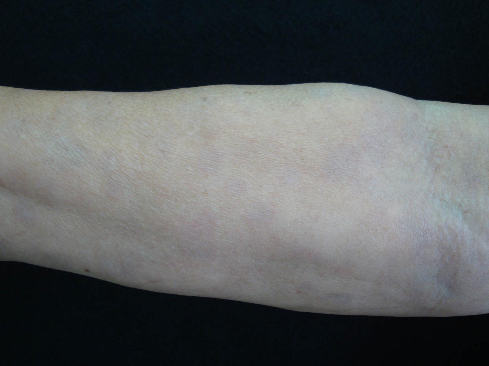 237 – Consulta a un Colega Nº 3: Máculas en miembros superiores – PIEL ...