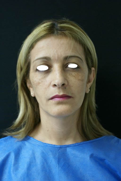Ojeras – PIEL-L Latinoamericana