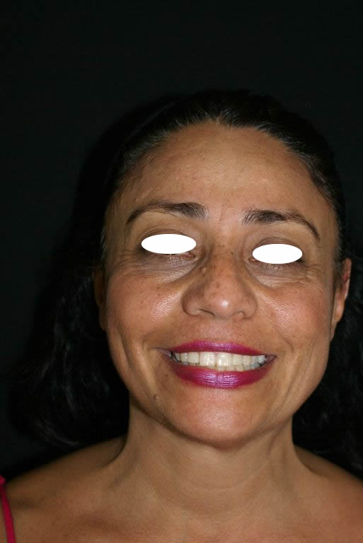 Ojeras – PIEL-L Latinoamericana