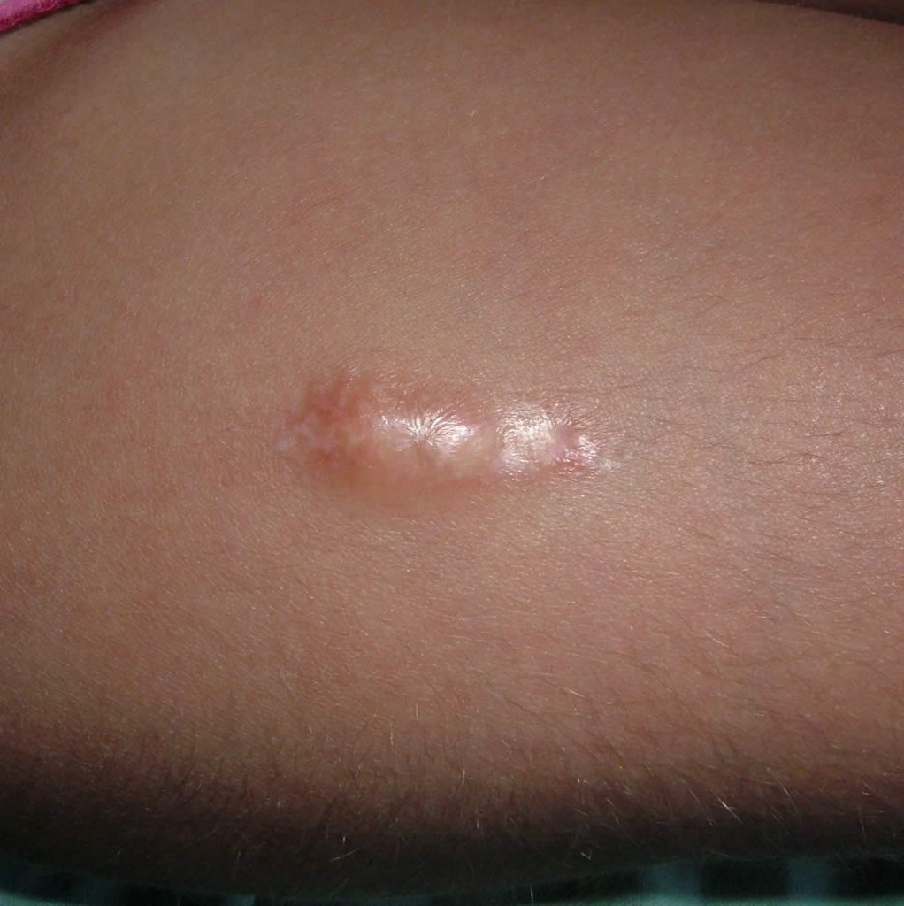 Esclerodermia – PIEL-L Latinoamericana