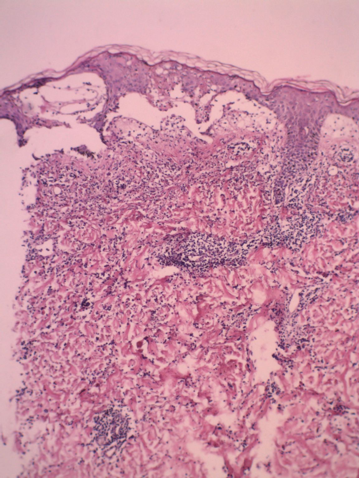 233 – Consulta a un Colega Nº2: Dermatitis Herpetiforme de Duhring ...