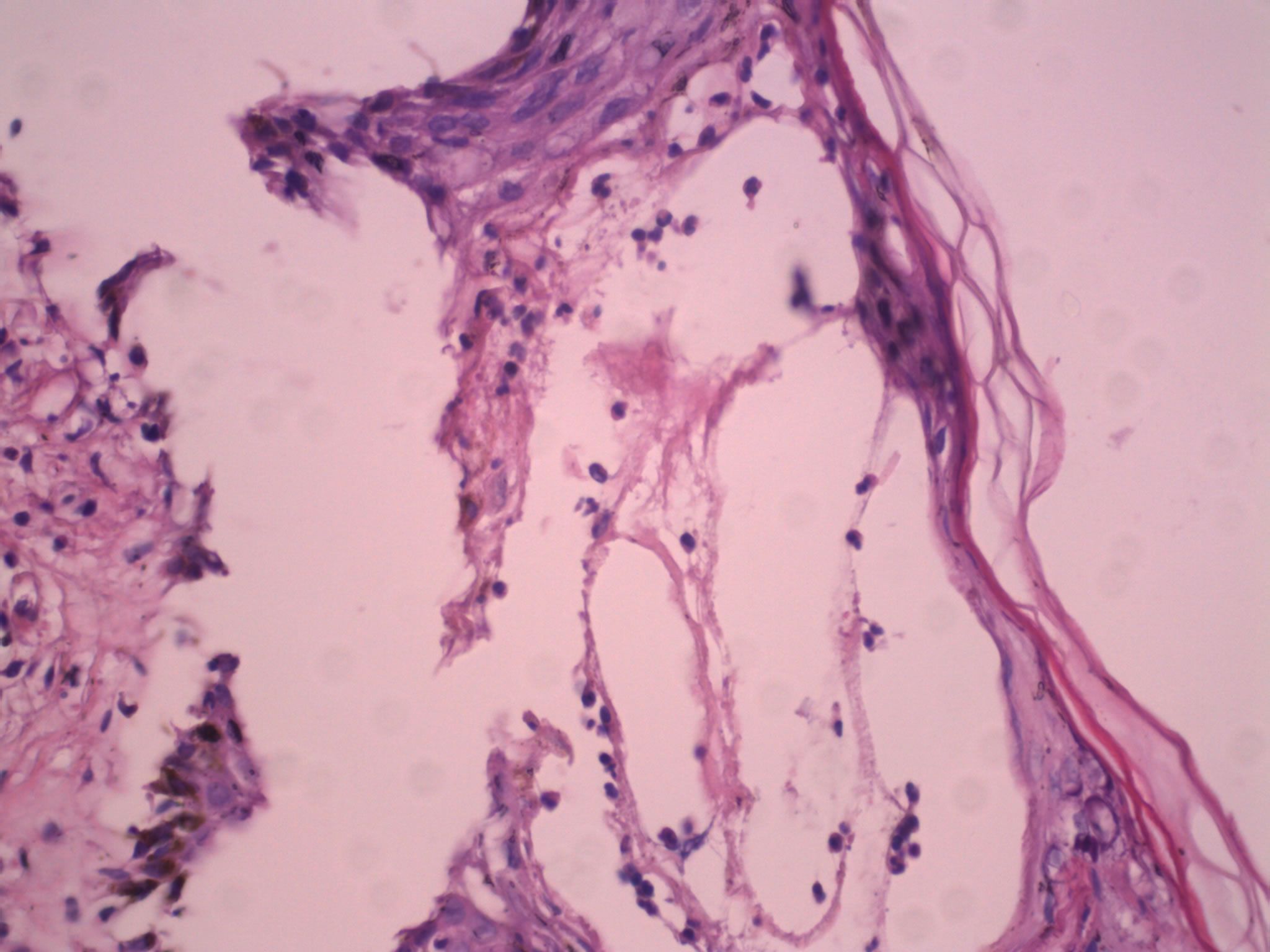 233 – Consulta a un Colega Nº2: Dermatitis Herpetiforme de Duhring ...