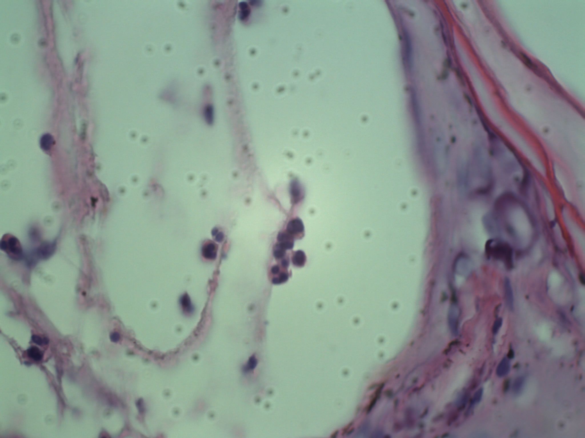 233 – Consulta a un Colega Nº2: Dermatitis Herpetiforme de Duhring ...