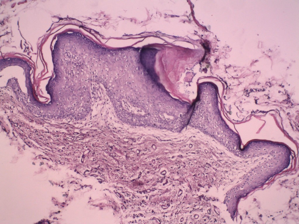 233 – Consulta a un Colega Nº1: Condiloma Acuminado. VPH? – PIEL-L ...