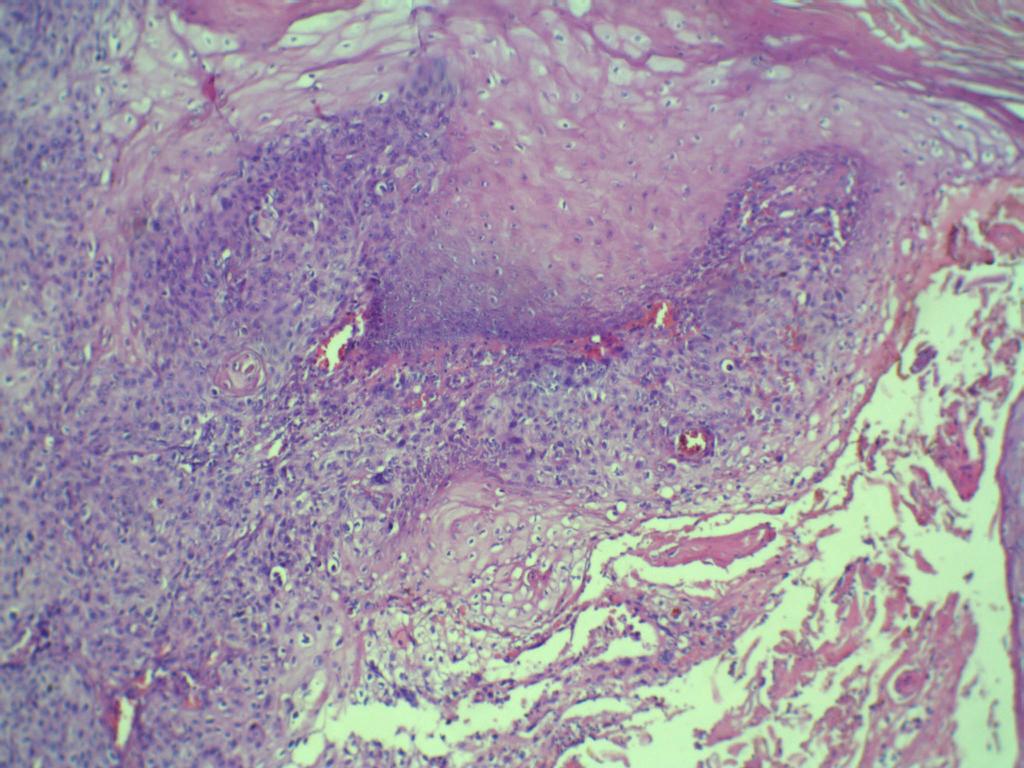 235 – Consulta a un Colega Nº2: Carcinoma espinocelular – PIEL-L ...