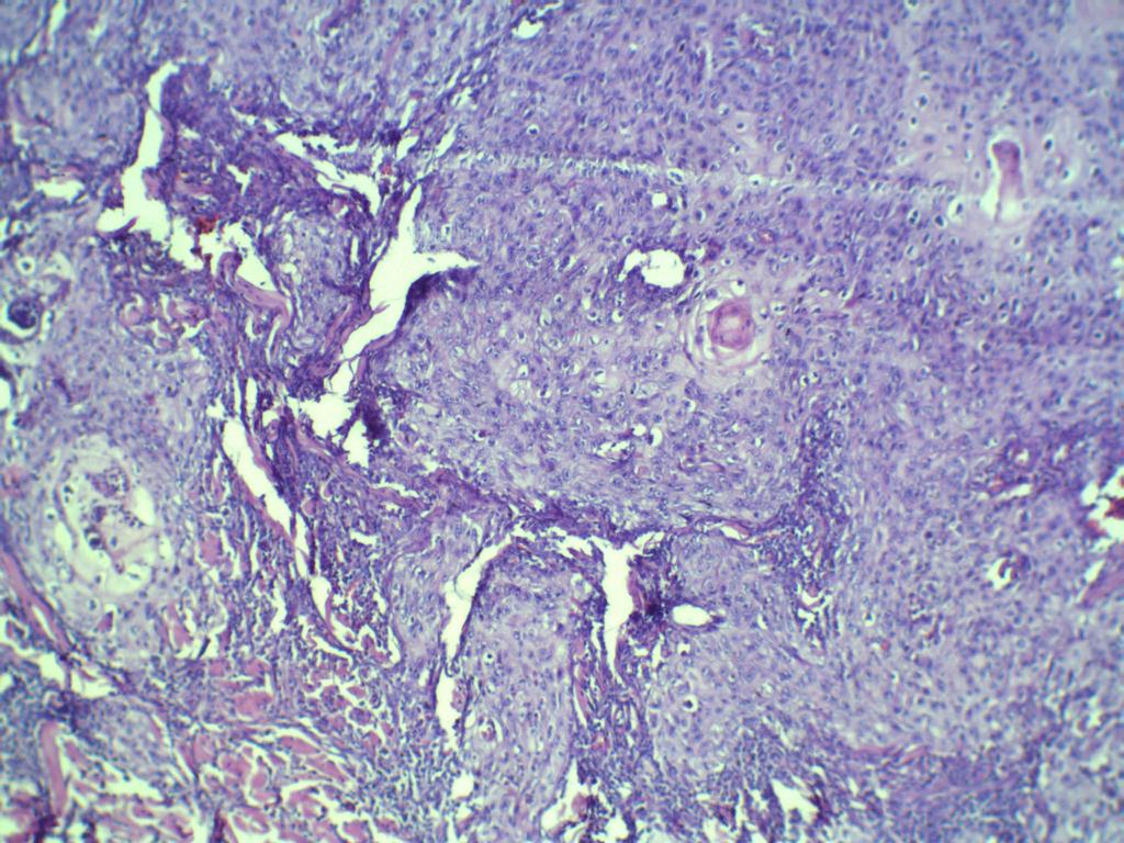235 – Consulta a un Colega Nº2: Carcinoma espinocelular – PIEL-L ...
