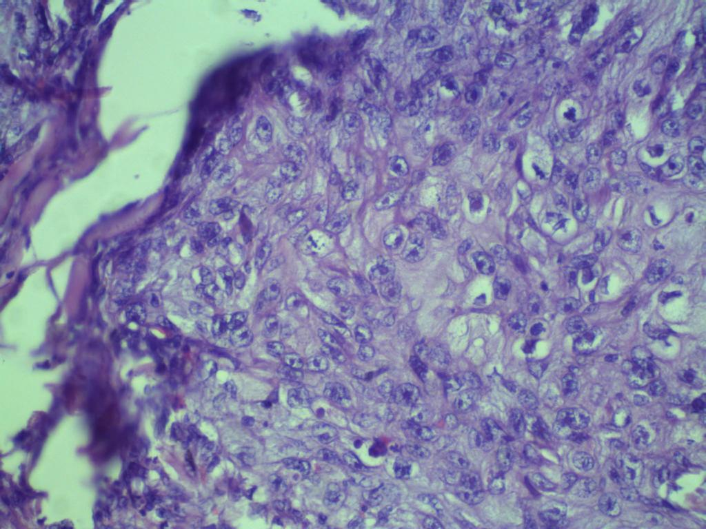 235 – Consulta a un Colega Nº2: Carcinoma espinocelular – PIEL-L ...