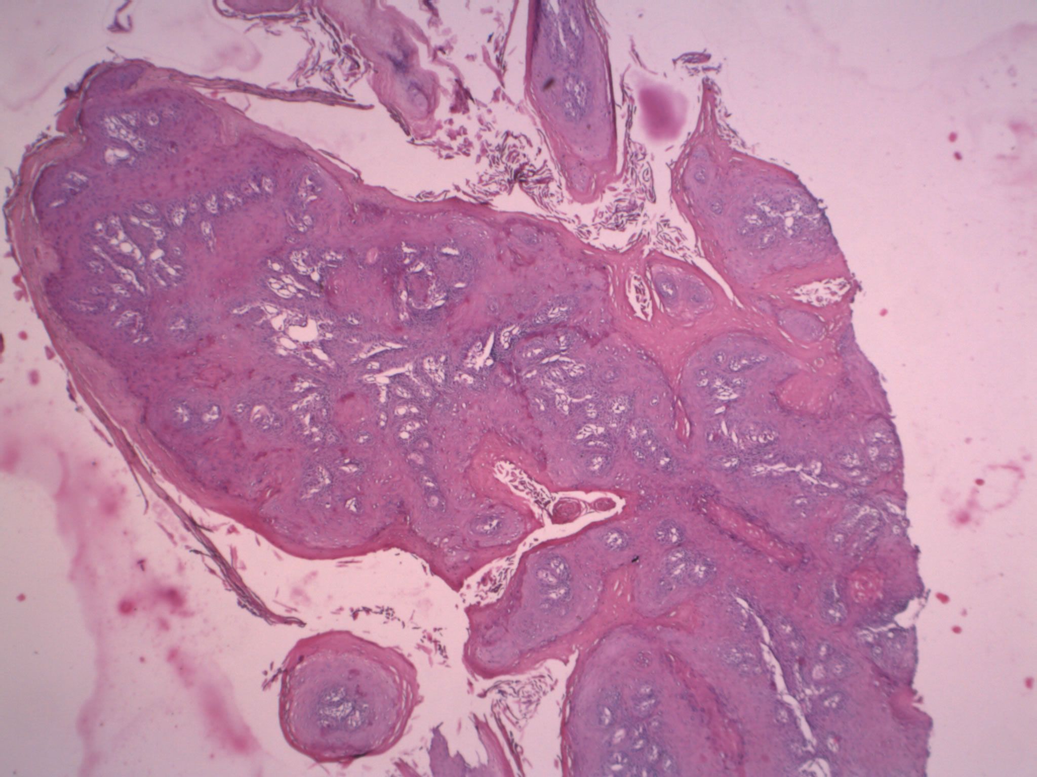 233 – Consulta a un Colega Nº1: Condiloma Acuminado. VPH? – PIEL-L ...