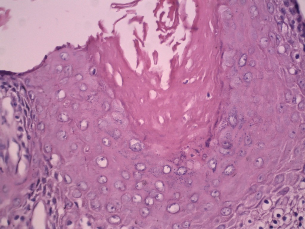 233 – Consulta a un Colega Nº1: Condiloma Acuminado. VPH? – PIEL-L ...