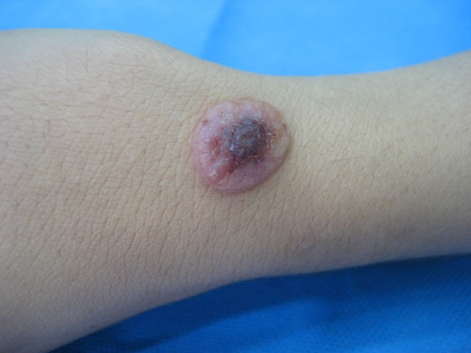 237 – Consulta a un Colega Nº1: Nódulo redondo, mamelonado con necrosis ...