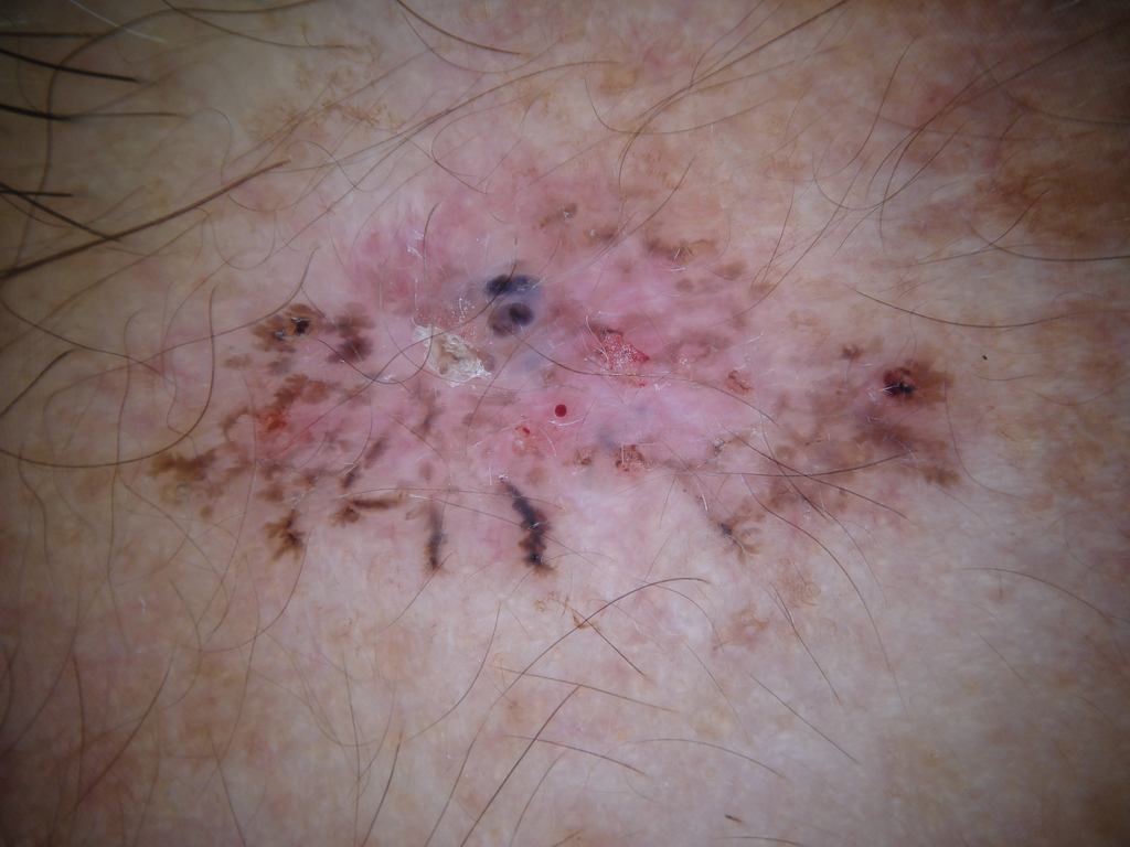 Dermatoscopia Edición 239 – PIEL-L Latinoamericana