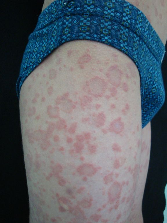 239 – Consulta a un Colega Nº2: Erupción en piel muy pruriginosa – PIEL ...