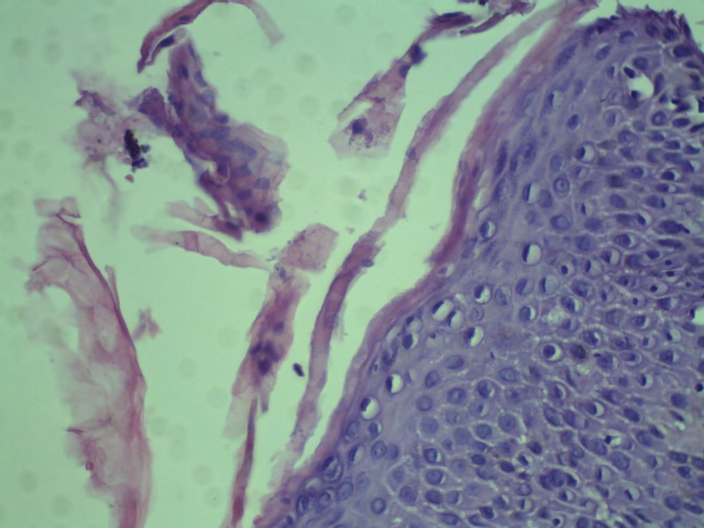 239 – Consulta a un Colega Nº2: Erupción en piel muy pruriginosa – PIEL ...