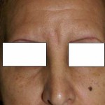 Mejorar surco marcado en el entrecejo – PIEL-L Latinoamericana