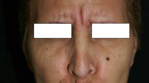 Mejorar surco marcado en el entrecejo – PIEL-L Latinoamericana