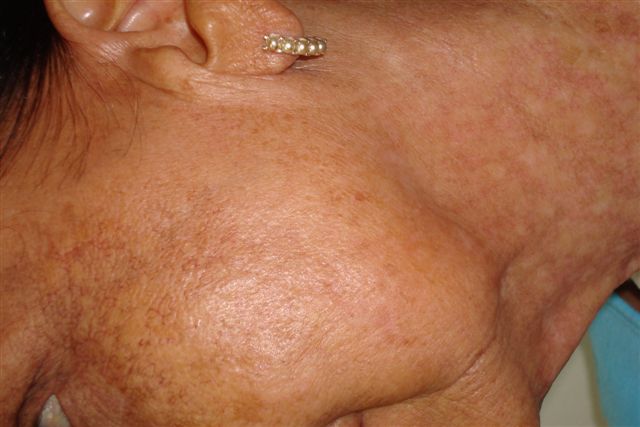 240 – Consulta a un Colega No 2: Poiquilodermia de Civatte + Fotodaño ...