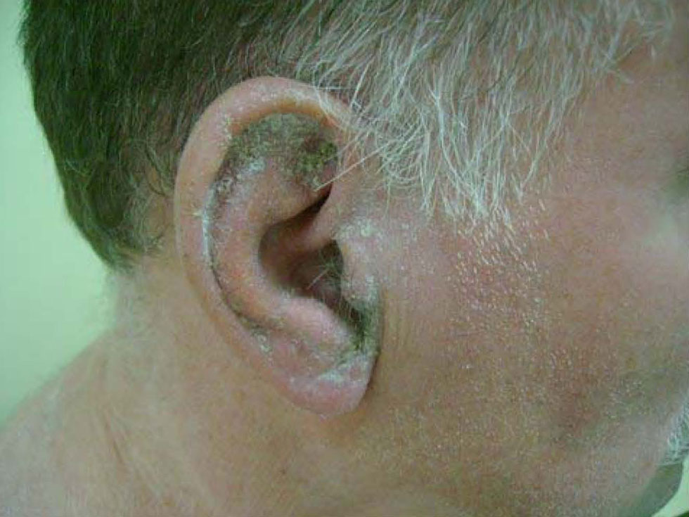 Casos para diagnósticos en apéndices auriculares y áreas pre ...