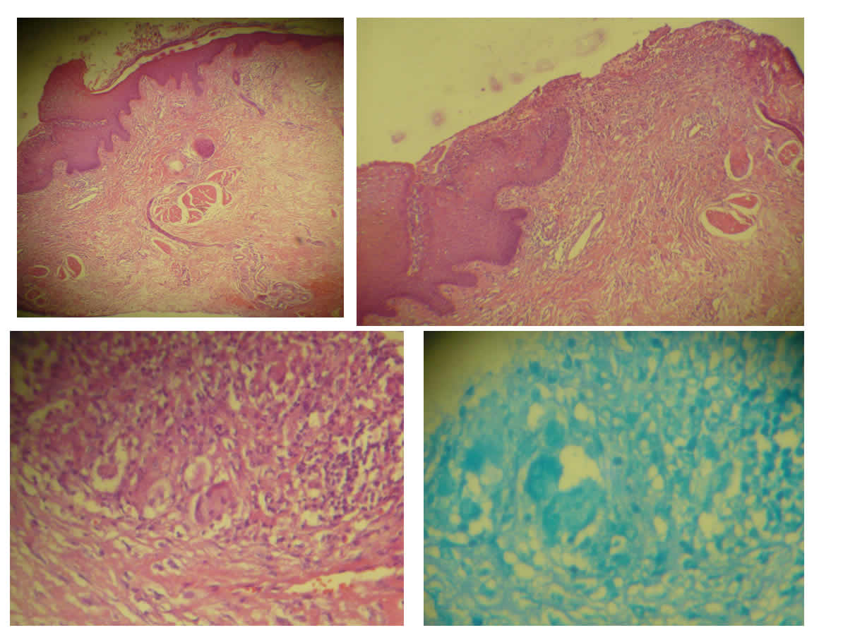 Tuberculosis Cutánea: Escrofuloderma – PIEL-L Latinoamericana