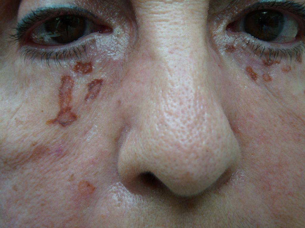 243 – Consulta a un Colega N°3 – PIEL-L Latinoamericana