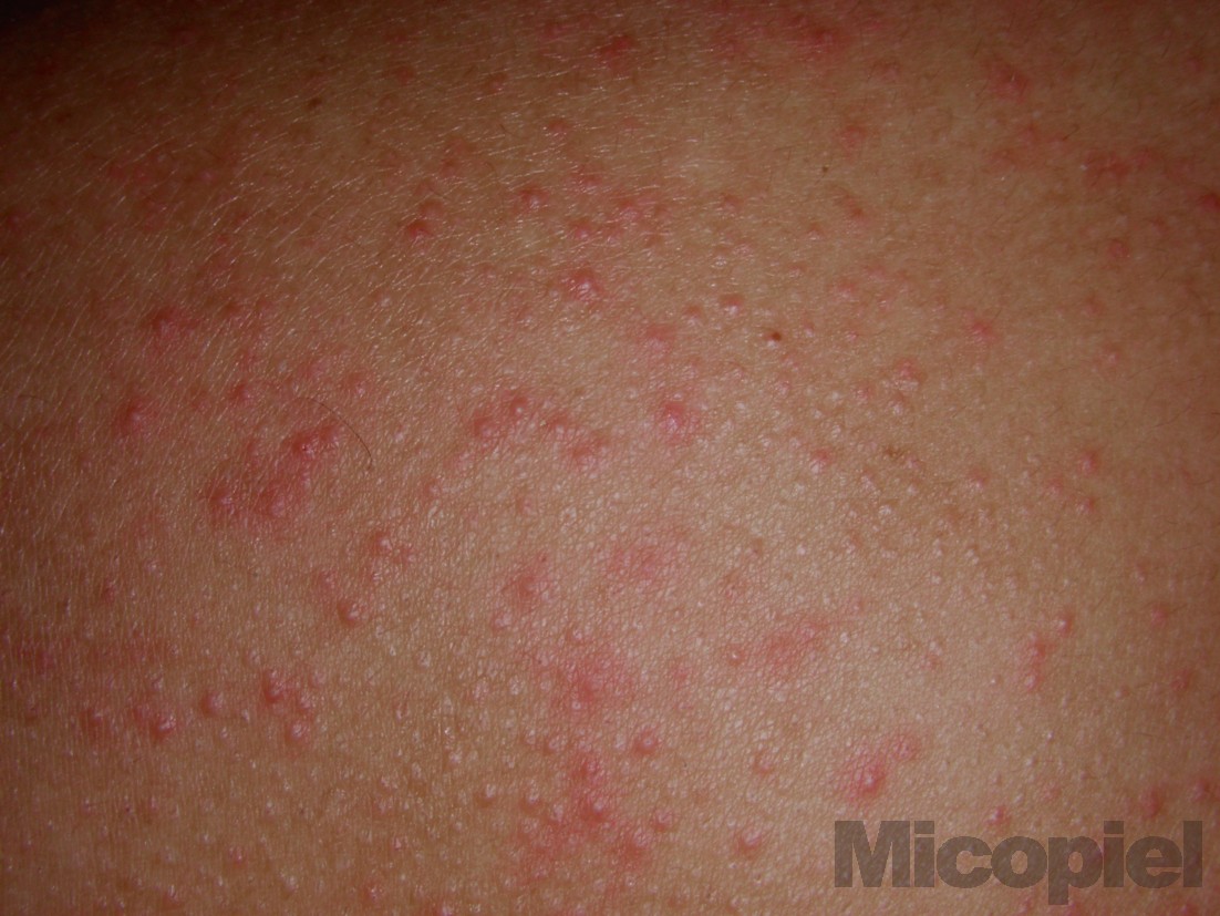 PIEL-L Latinoamericana – Caso clínico Nº 38. Foliculitis por Malassezia