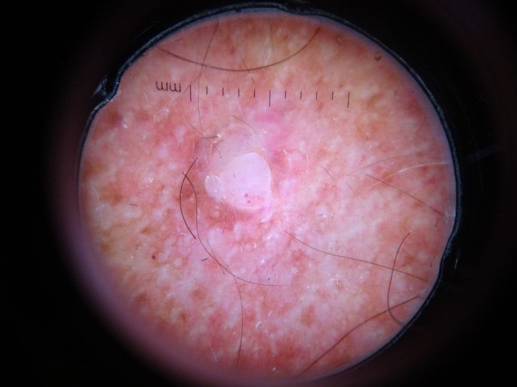 Dermatoscopia Edición 243 – PIEL-L Latinoamericana