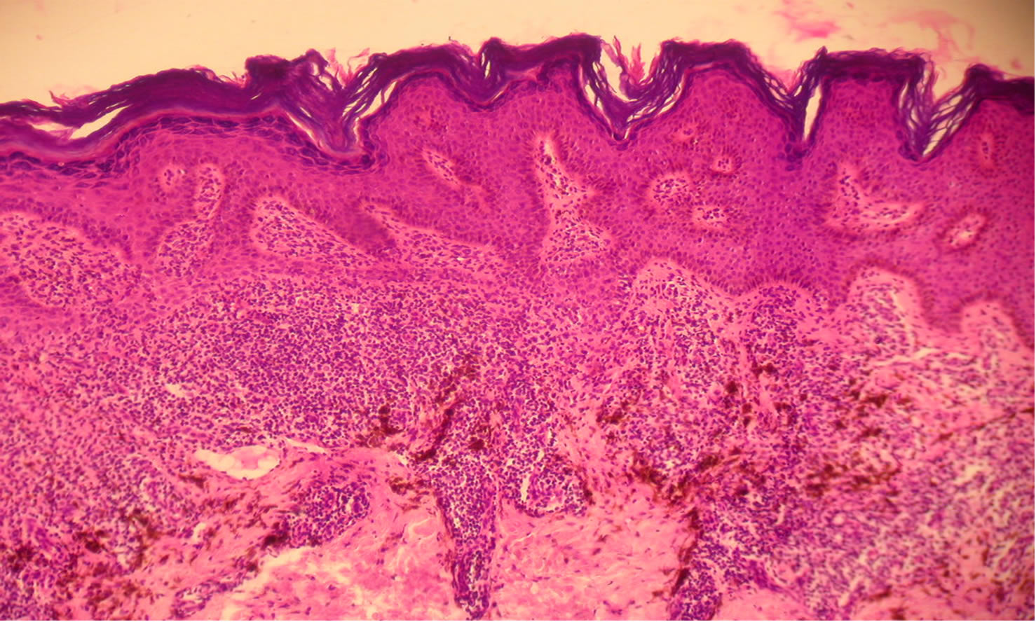 245 – Consulta a un Colega Nº 2: Múltiples pápulas, redondeadas en cara ...