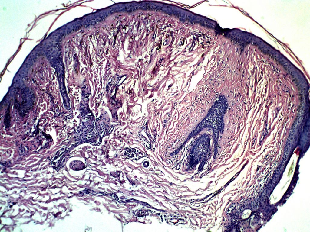 245 – Consulta a un Colega Nº 5: Diverticulitis-Tumor renal – PIEL-L ...