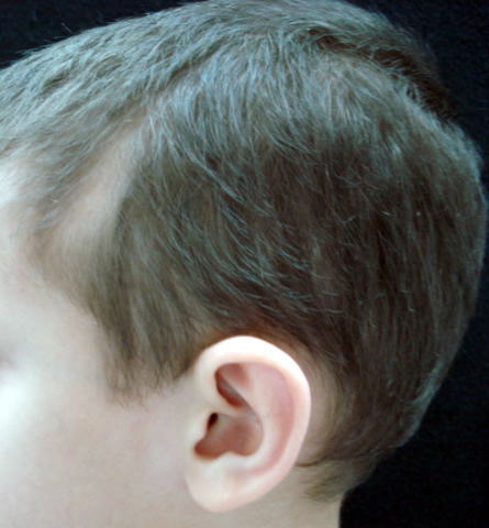 245 – Consulta a un Colega Nº 6: Alopecias triangular temporal desde el ...